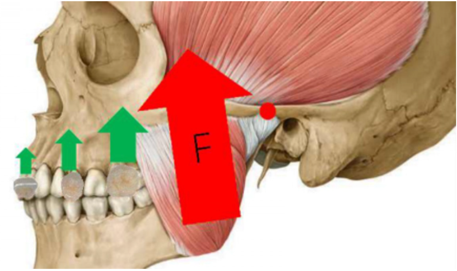 The recipe for the perfect implant-prosthesis – IDI Evolution
